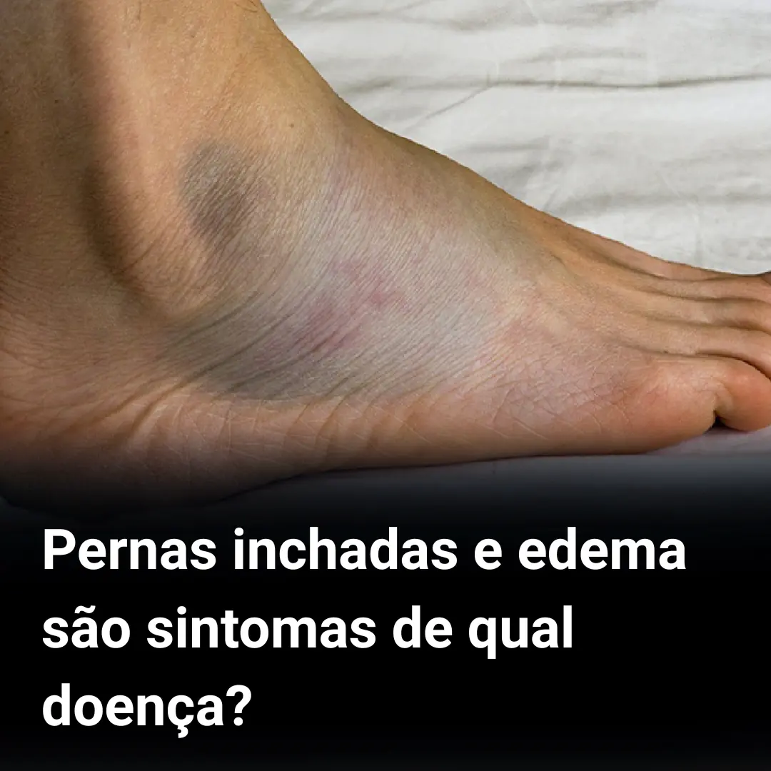 Dilatação e fragilidade das veias que podem levar ao inchaço.