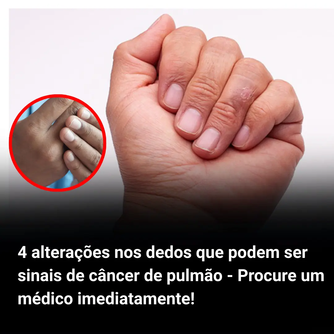4 alterações nos dedos que podem ser sinais de câncer de pulmão ...