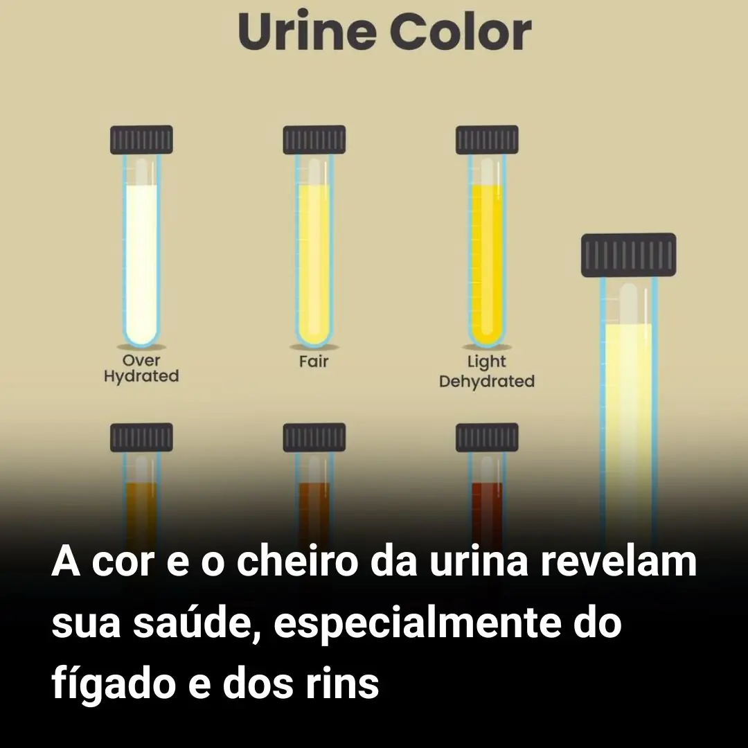 A cor e o cheiro da urina revelam sua saúde, especialmente do fígado e ...