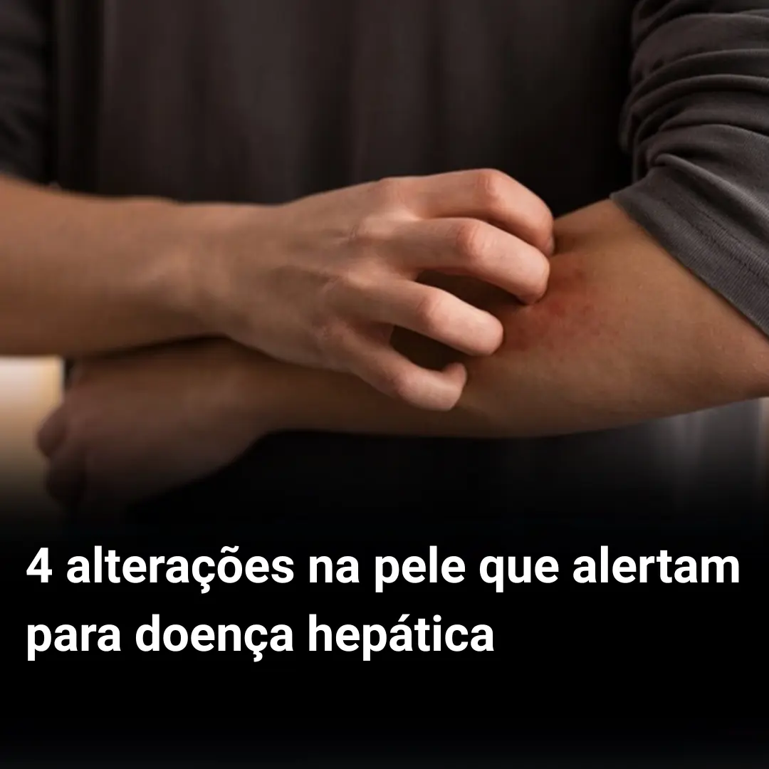 4 alterações na pele que alertam para doença hepática.