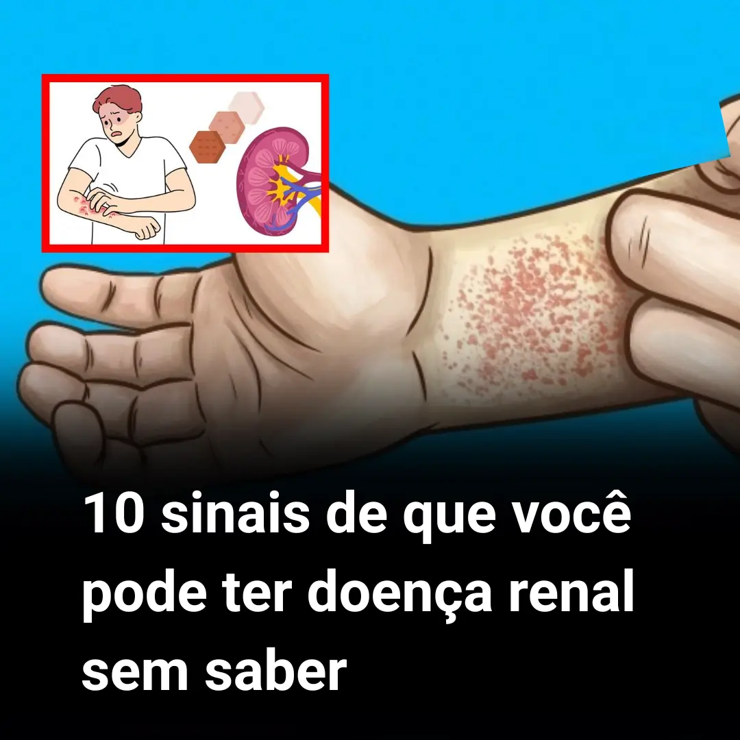10 sinais de que você pode ter doença renal sem saber