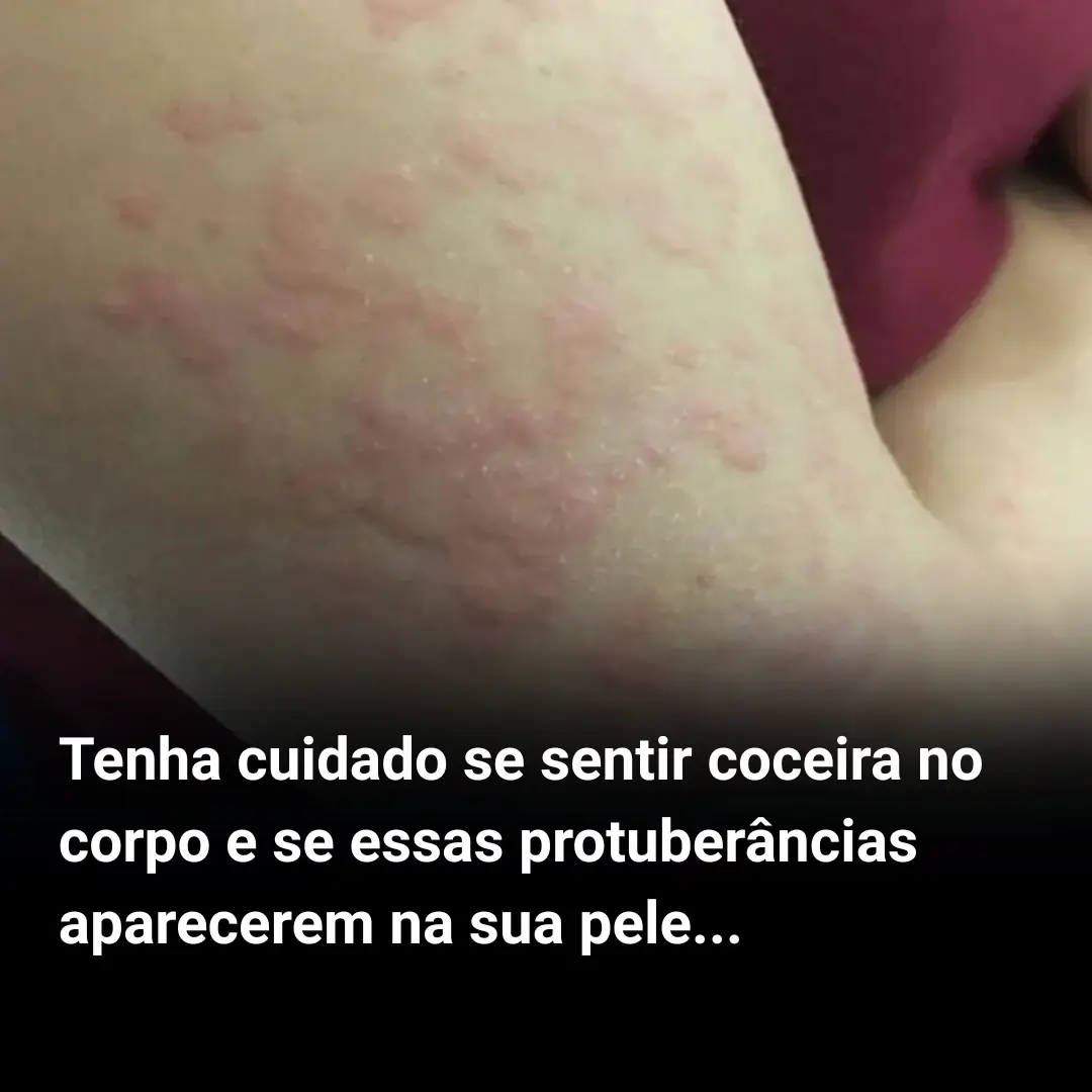Atenção: Se sentir coceira no corpo e notar essas protuberâncias na ...