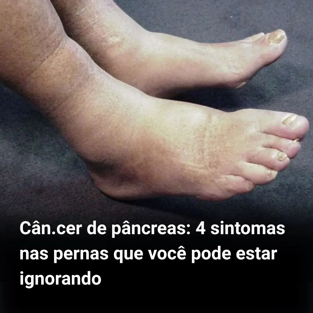 Câncer de pâncreas: 4 sintomas nas pernas que você pode estar ignorando